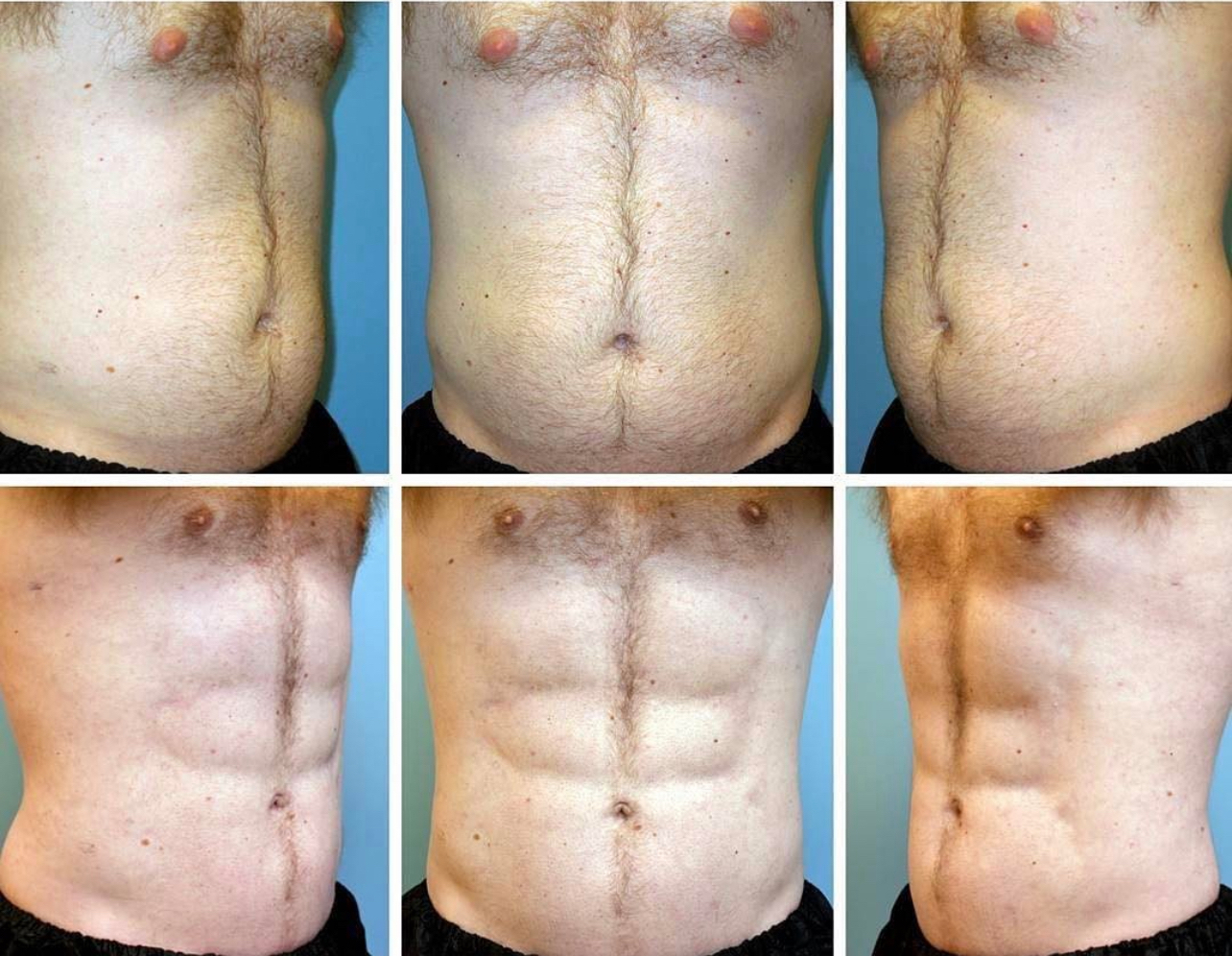 7 choses à savoir sur l'etching abdominal : sculpter ses abdos sans ...